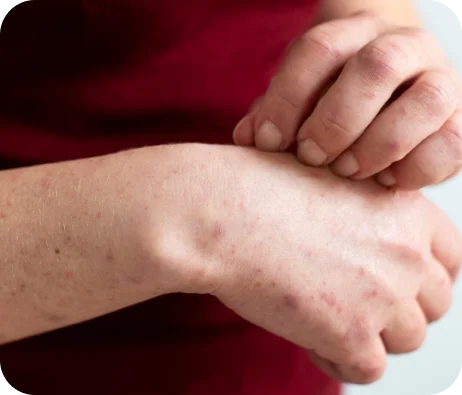 Post-Thrombotic Syndrome | Charming Skin Vein Clinics | Oak Brook